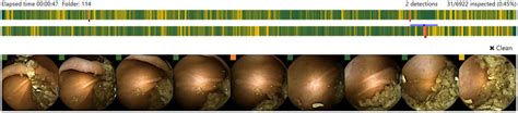 Candidate Polyp Sequence Displayed In The Ai Tool Each Colored Bar