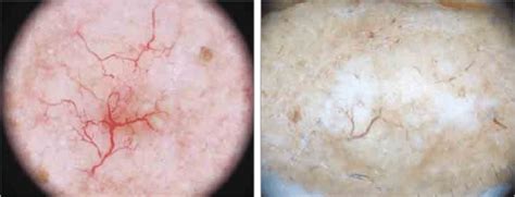 Example Of Basal Cell Carcinoma Bcc Download Scientific Diagram