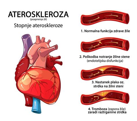 Infografika Stopnje Ateroskleroze Društvo Za Zdravje Srca In Ožilja