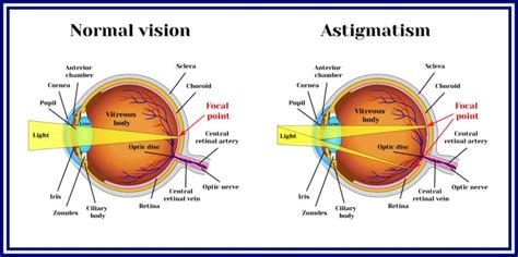Lasik For Astigmatism Success Rates Costs And Recovery