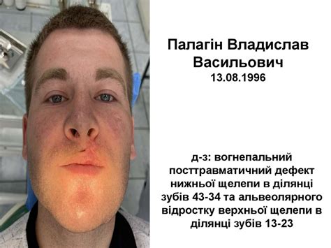 Палагін презентація після операції Online Presentation