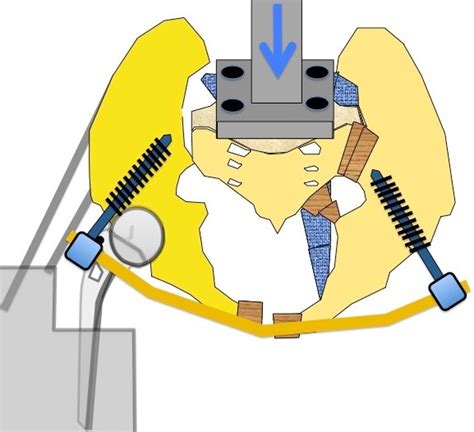 Loading Of The Construct With The Instron 200n Or 15 Mm Download