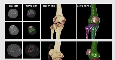 Ai 기반 정형외과 치료 소프트웨어 ‘카비랩 딥러닝 기반 임상시험 결과 국제 학술지 ‘사이언티픽 리포트 게재