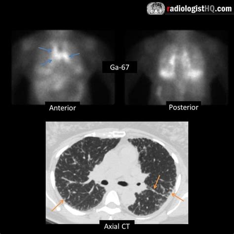 Sarcoidosis On Ct And Gallium 67 Scan Rradiology