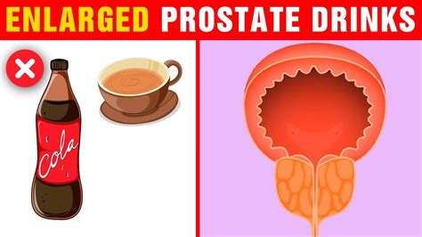 7 Drinks To Avoid With An Enlarged Prostate Youtube