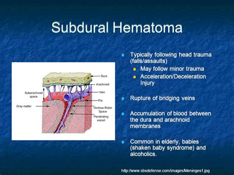 Subdural Hematoma Bridging Veins