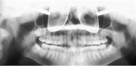 Panoramic Positioning Errors Flashcards Quizlet