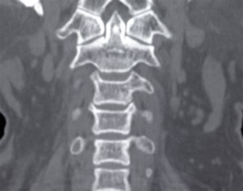 Abnormal Cervical Spine Mri