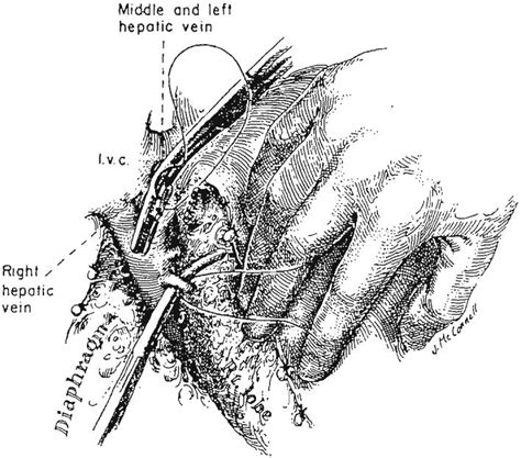 Hepatic Trisegmentectomy And Other Liver Resections Pmc