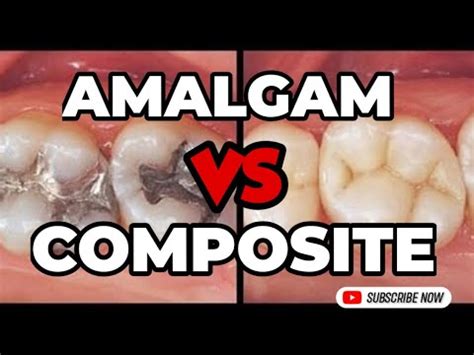 Amalgam Vs Composite Fillings ALL REVEALED YouTube