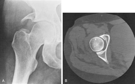 Hip Dislocations Clinical Tree