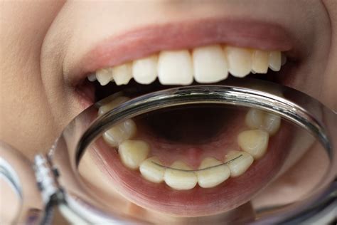 Permanent Retainer 8 Things To Know Orthodontic Arts