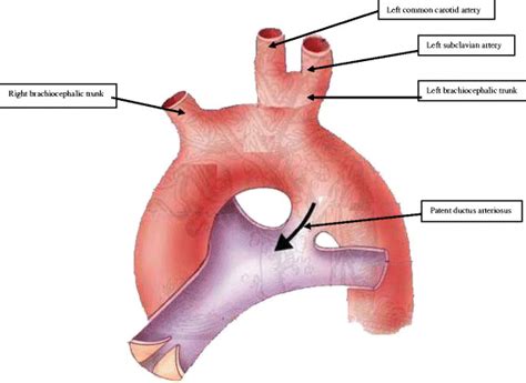 Patent Ductus Arteriosus Animation