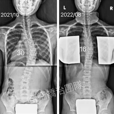 脊椎側彎矯正案例分享｜不容忽視的幼童型脊椎側彎｜drspine 衡觀診所 成果分享 Drspine 衡觀診所