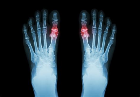 Patients With Early Onset Gout Develop Earlier Metabolic Comorbidities