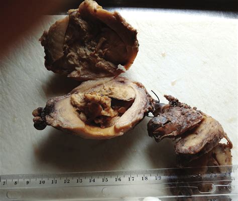 A Friable Grayish White Mass Filling The Endometrial Cavity With A