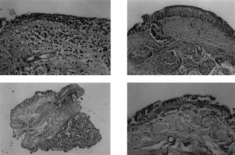 Biopsy Sections Stained With He From A A Subject With Copd Revealed