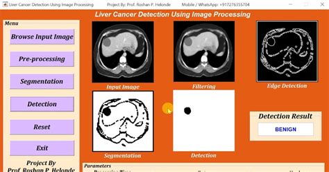 Liver Cancer Detection Using Image Processing Matlab Project With