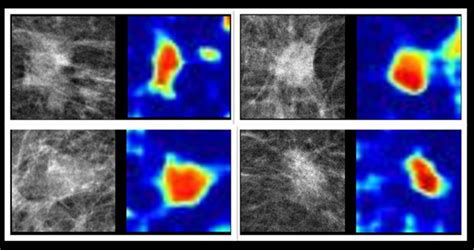 Evaluation Of Deep Learning‐based Artificial Intelligence Techniques For Breast Cancer Detection