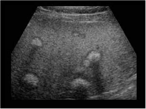 Abdomen And Retroperitoneum 11 Liver Case 119 Metastases