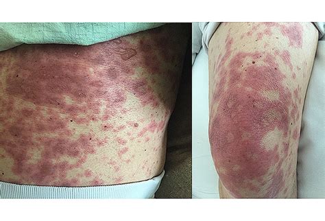 11 Rheumatologic Findings Not To Miss