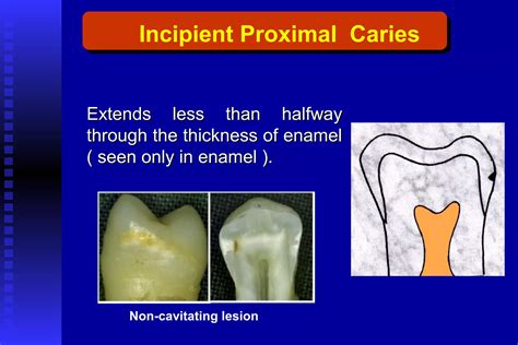 Radiographic Assessment Of Dental Caries Ppt