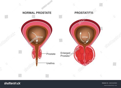 La Prostatitis Es La Inflamación De Vector De Stock Libre De Regalías