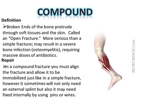 Compound Fracture Diagram