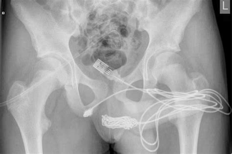 Terungkap Remaja Ini Masukkan Kabel USB Ke Alat Kelamin Untuk Mengukur Panjangnya