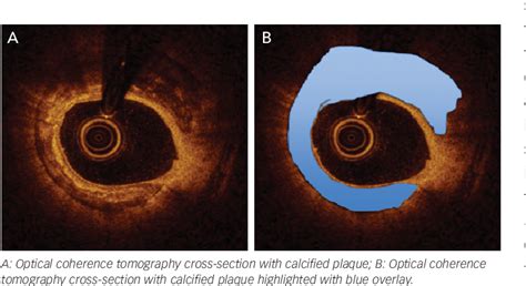 Figure 1 From Lesion Preparation With Orbital Atherectomy Semantic