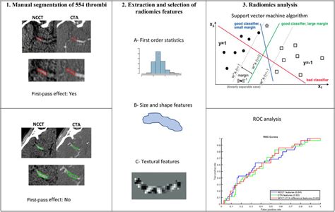 Workflow Of The Main Stages Of Radiomics Thrombus Analysis The First