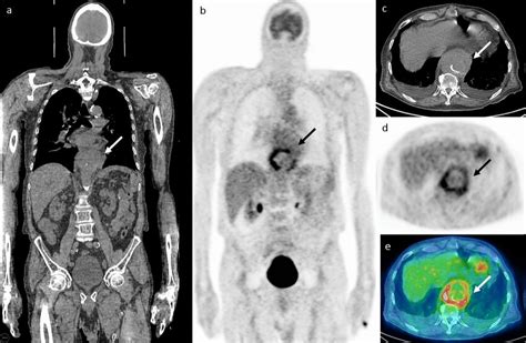 Infectious Focus In An Aortic Pseudoaneurysm A 73 Year Old Male