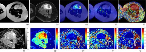 A 32 Year Old Woman Affected By A High Grade Myxoid Liposarcoma Of The