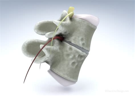 Sciatica Treatment Lewes Sciatica Explained