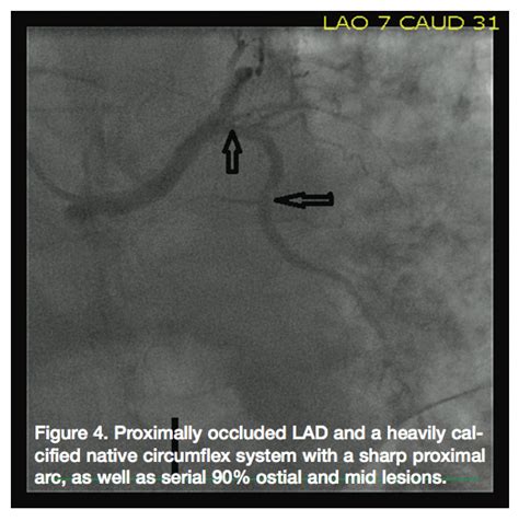 Single Catheter Technique For Transradial Catheterization In Bypass