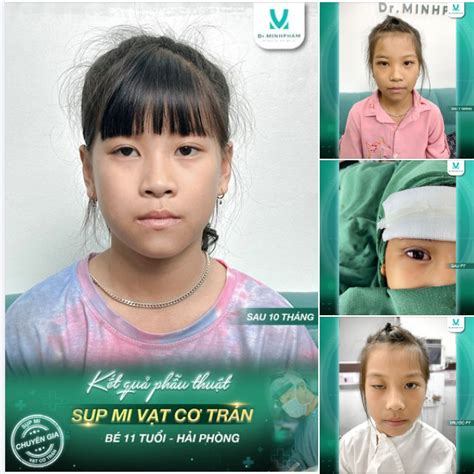 10 tháng lột xác ngoạn mục của bé Mai Anh sau phẫu thuật sụp mí