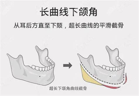 国内长曲线下颌角整形医院排名前三圣嘉新美联臣等居前3下颌角整形 8682整形网