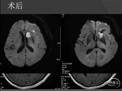 浙大二院石键主任医师 华科导航dti成像技术在岛叶脑肿瘤手术中的应用 脑医汇 神外资讯 神介资讯