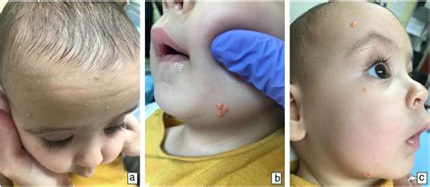 Yellow Papules On The Face And Scalp Anales De Pediatría