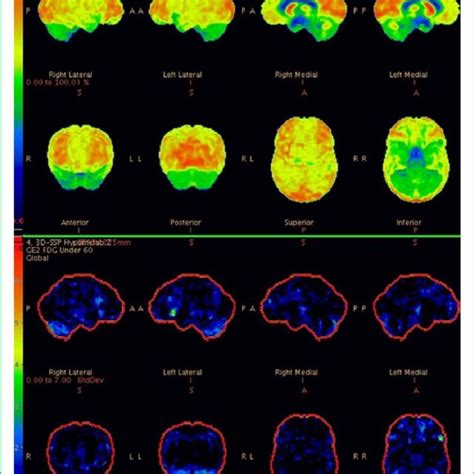 Bilateral Metabolic Reduction In The Frontal Parietal Temporal