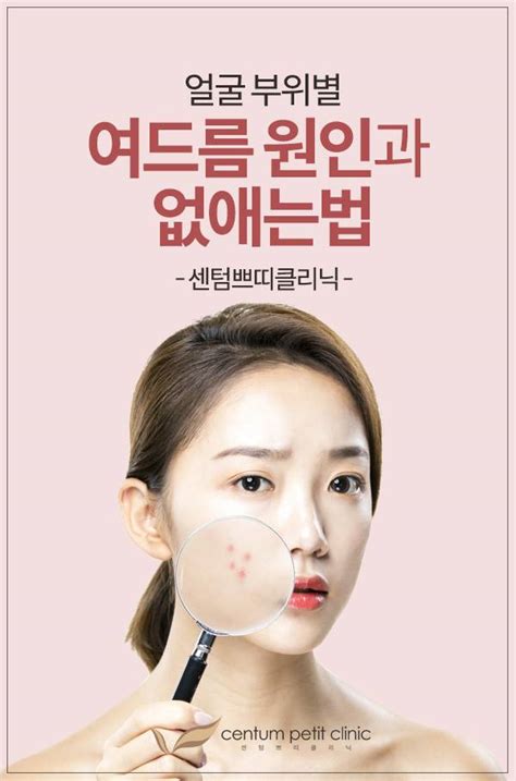 센텀쁘띠클리닉 얼굴 부위별 여드름 원인과 없애는 법 계속되는 폭염주의보 피지분비가 늘어 얼굴에