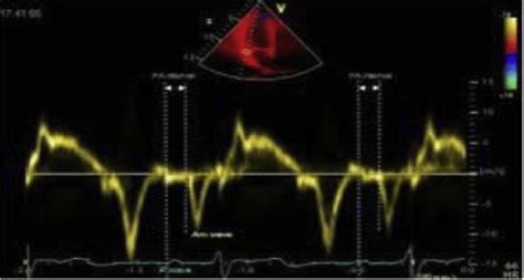 Measurement Of Interatrial Conduction Time Pp 138 Download