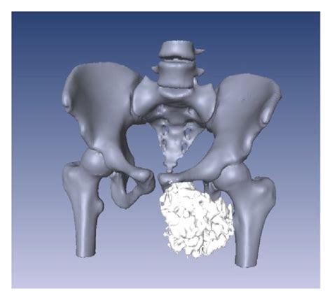 A Ct Reconstruction Of The Pelvis Of A 15 Year Old Girl With A