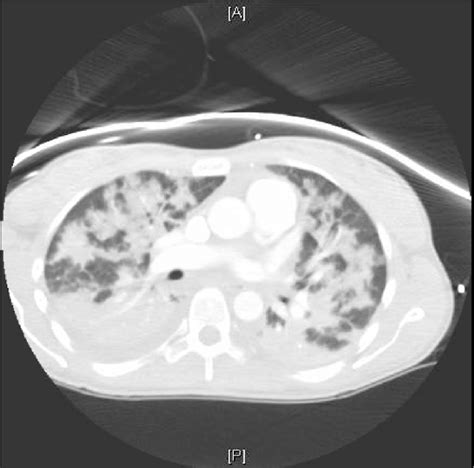 Chest CT With IV Contrast Obtained At The Onset Of Respiratory Download Scientific Diagram