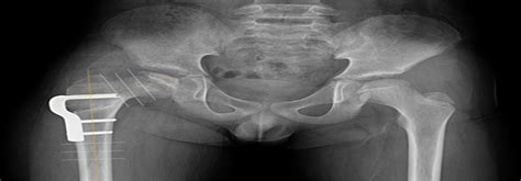 Effect Of Postoperative Femoral Neck Shaft Angle On Femoral