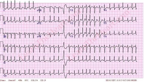 Atrial Fibrillation With RVR ECG 5 LearntheHeart