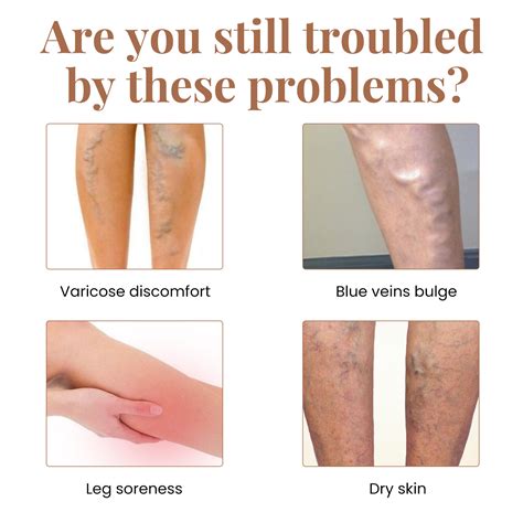 Varicose Veins Treatment Cream Vasculitis Phlebitis Massage Relieve
