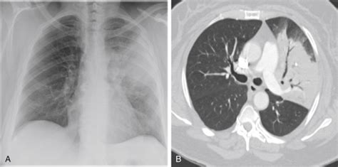Segmental And Lobar Consolidations Radiology Key