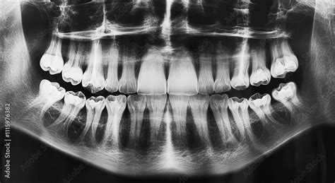 Detailed Radiographic Image Of Human Mandibular And Maxillary Teeth