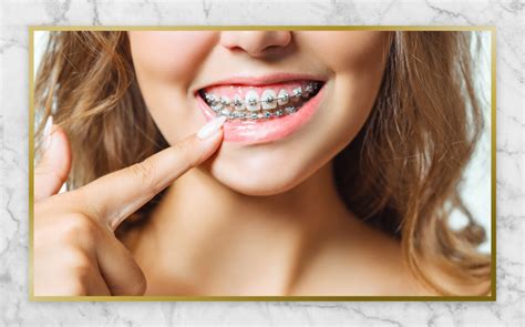Damon Self Ligating Braces Ads Clinic